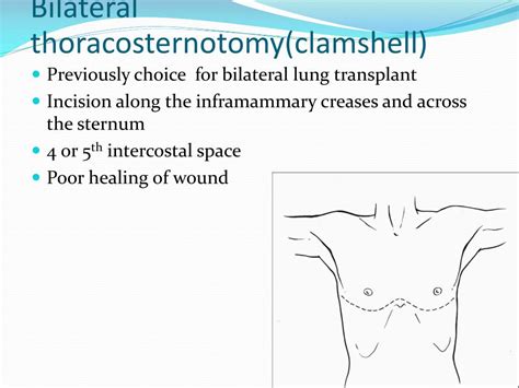 Clamshell Thoracotomy