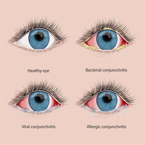 Bacterial Conjunctivitis
