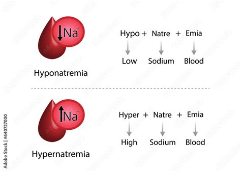 Vecteur Stock Hypernatremia High Plasma Sodium Level And Hyponatremia