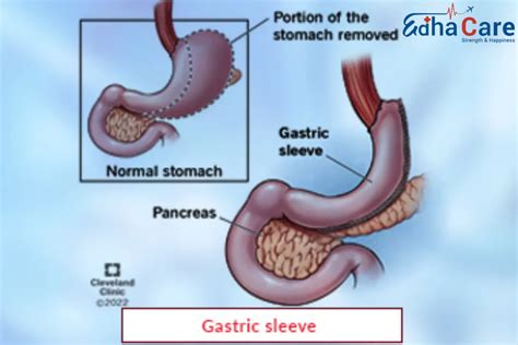 Gastric Bypass Surgery Gastric Bypass Treatment Edhacare