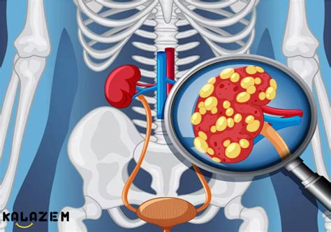 کیست کلیه چیست؟ چه افرادی مبتلا به کیست کلیوی می شوند؟ عللعلائمدرمان