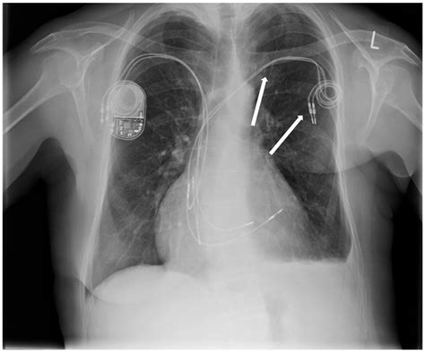 Jpm Free Full Text Abandoned Intracardiac Electrodes In An