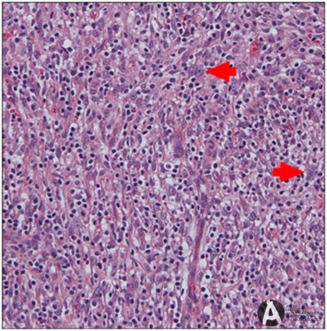 Follicular Dendritic Cell Sarcoma