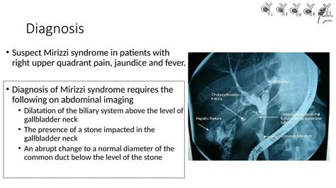 Management And Diagnosis Of Mirizzi Syndromepptx