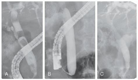 Management Of Biliary Lithiasis Abdominal Key