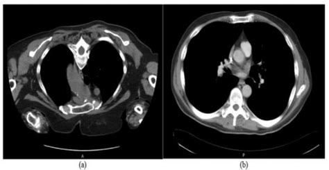 Figure 1 From Lung Cancer Detection Using Segmented 3d Tensors And Support Vector Machines