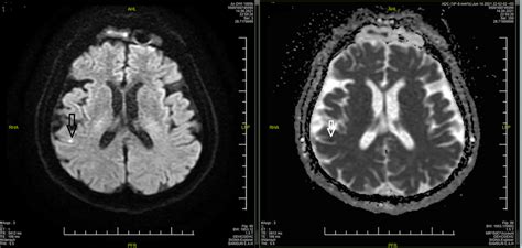 In The Right Temporal Lobe A Focal Millimetric Lesion Consistent With Download Scientific