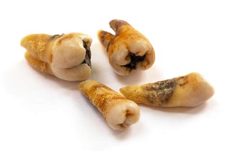 Premium Photo A Close Up Tooth With Severe Tooth Decay Also Known As