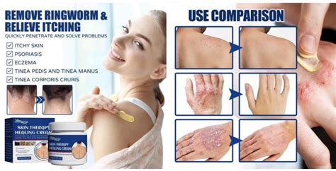 ដំណោះស្រាយ ដំណោះស្រាយ បញ្ហាសើស្បែក គ្រប់ប្រភេទ 0887070156