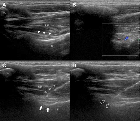 Figure 1 From Does Combining A Suprascapular Nerve Block With An Intra Articular Corticosteroid