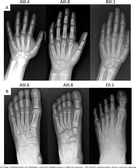 Figure 2 From Ihh Gene Mutations Causing Short Stature With Nonspecific