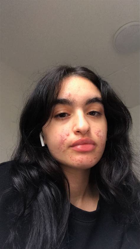 Makes You Beautiful Most Beautiful Faces Acne Skin Skin Care Acne Bare Beauty Real Beauty