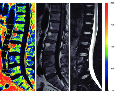 Color Fat Fraction Map And Non Fat Suppressed T1 Weighted And