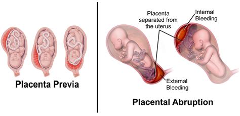 Vaginal Bleeding During Pregnancy Dr Sherif Ashoush Clinic
