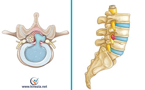 Дискова херния Всичко което трябва да знаете за да се избегне операцията Кинезия