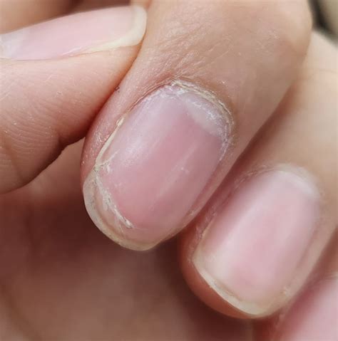 손톱 갈라짐 지식in