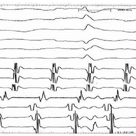 An Example Of A Counter Clockwise Atrial Flutter With Negative F Waves Download Scientific