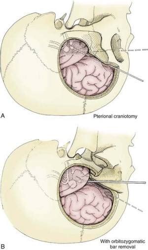 Orbitozygomatic Approach [neurosurgery Education Wiki]