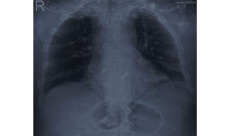 Micra Leadless Pacemaker Insertion Techniquepptx