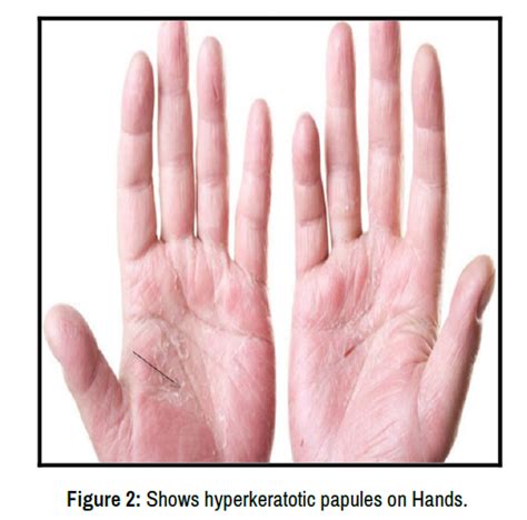 Verruca Palmaris Palmoplantar Keratoderma Rare Case Report
