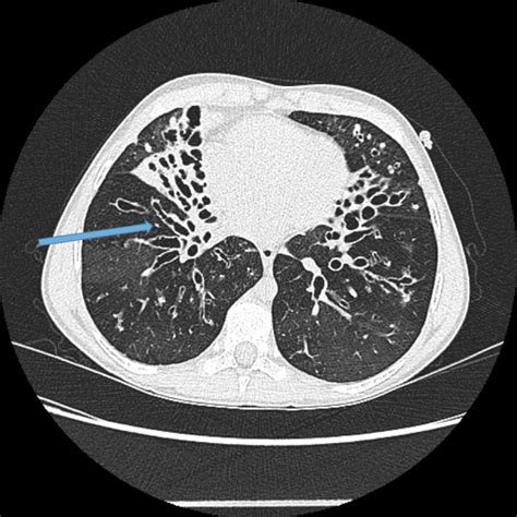 Radiology Bronchiectasis Radiology Radiology Imaging Pulmonology