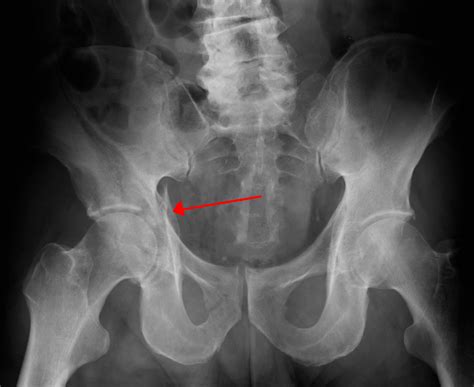 Acetabular Fracture Wikipedia