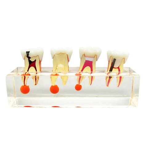 Drsk Endodontic Models Dental Root Canal Treatment Model Educational