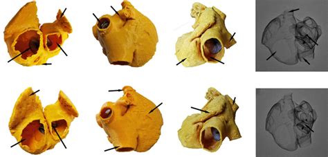 A D The 3dp Simulation For The Asd Occluder While E H Show That Download Scientific