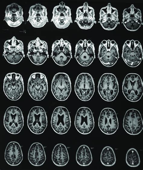 Bilateral Frontoparietal Acute Infarcts And Hyperintensity Over The Download Scientific Diagram