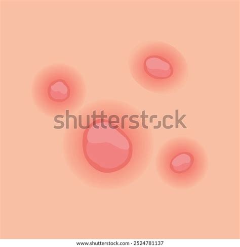 Understanding Type Acne Comprehensive Visual Guide Stock Vector Royalty Free 2524781137