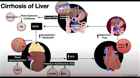 Liver Cirrhosis Ascites 1c Pathophysiology Youtube