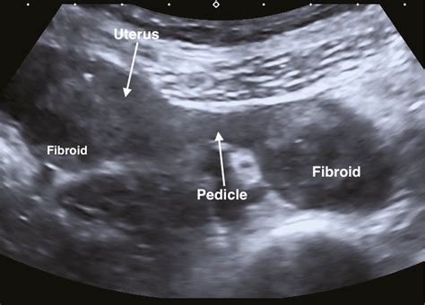 Uterus Ultrasounds Of Abnormal Looking Pelvic Ultrasound Johns