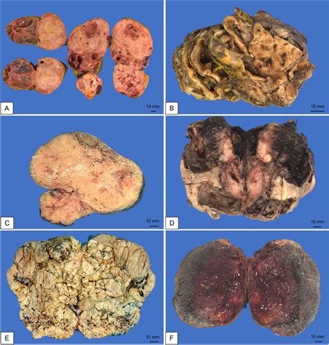 Intraoperative Frozen Section Evaluation Of Ovarian Sex Cord Stromal