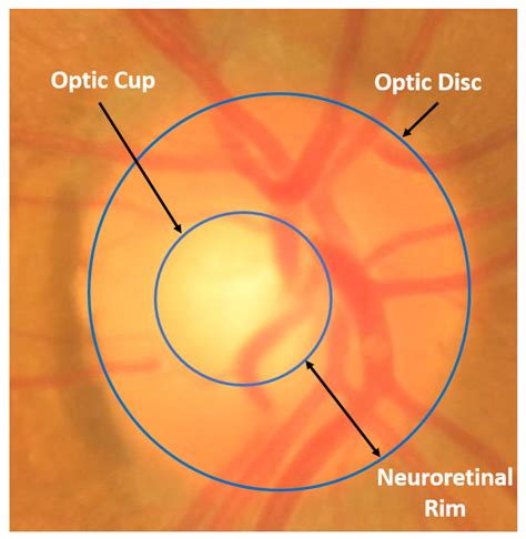 Optic Disc Glaucoma Diagnosis At Tia Curtis Blog