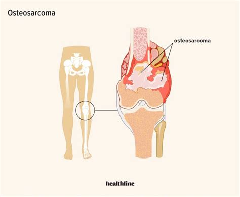 Osteosarcoma Also Called Osteogenic Sarcoma Is The Most Common Type Of Cancer That Starts In