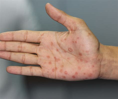 Syphilis Std Test London Syphilis Testing Near Me