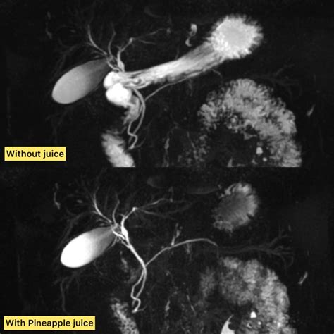 Vahid Shahmaei On Linkedin Mrcp Mri Radiology 36 Comments