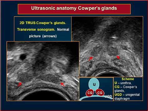 Figure 1 From The Normal Ultrasonic Anatomy Cowpers Glands In Adults