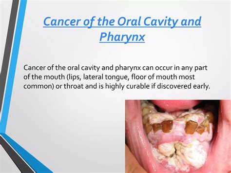 Cancer Of Oral Cavity Easy Explanation For Nurses Pdf