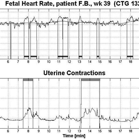Ctg Trace In Which The Software Recognised All Kinds Of Accelerations Download Scientific