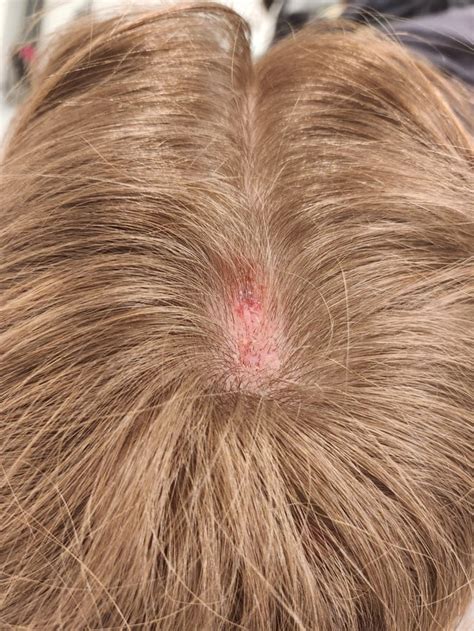 Excessive Scalp Picking Looking For Advice From People Who Have Beat The Habit R