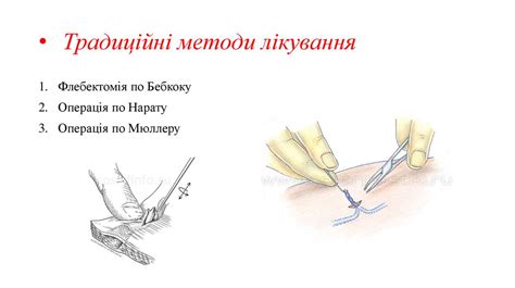 Варикозна хвороба нижніх кінцівок презентация онлайн