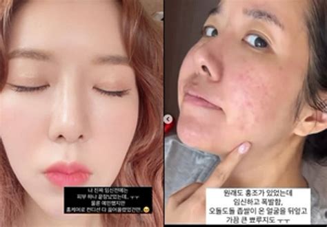 ‘쌍둥이 임신 김지혜 좁쌀로 뒤덮인 얼굴에 충격 피부 하나 끝장났었는데”