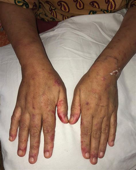 Lupus Rash On Hands