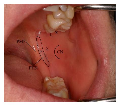 Nerve Block Mandibular Nerve Block Technique Nerve Block Mandibular