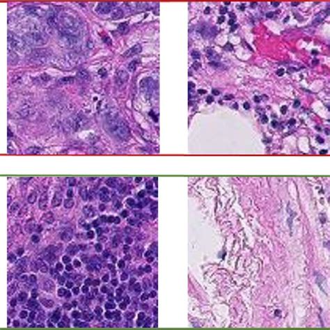 Two Types Of Pathological Findings For Lymph Node Sections Red 1st Download Scientific