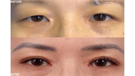 Canthoplasty In Korea Cost Clinics And More June 2024