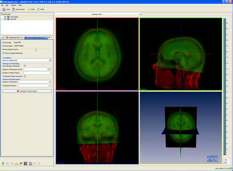 Medical Imaging Interaction Toolkit The Deformable Image Registration View