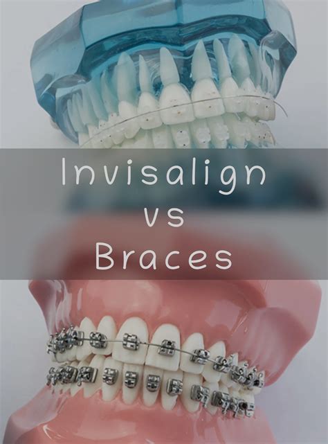 Invisalign Vs Braces Which Is Best For Your Smile