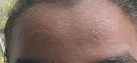 [acne] Acne Scarring Pock Marks R Skincareaddiction